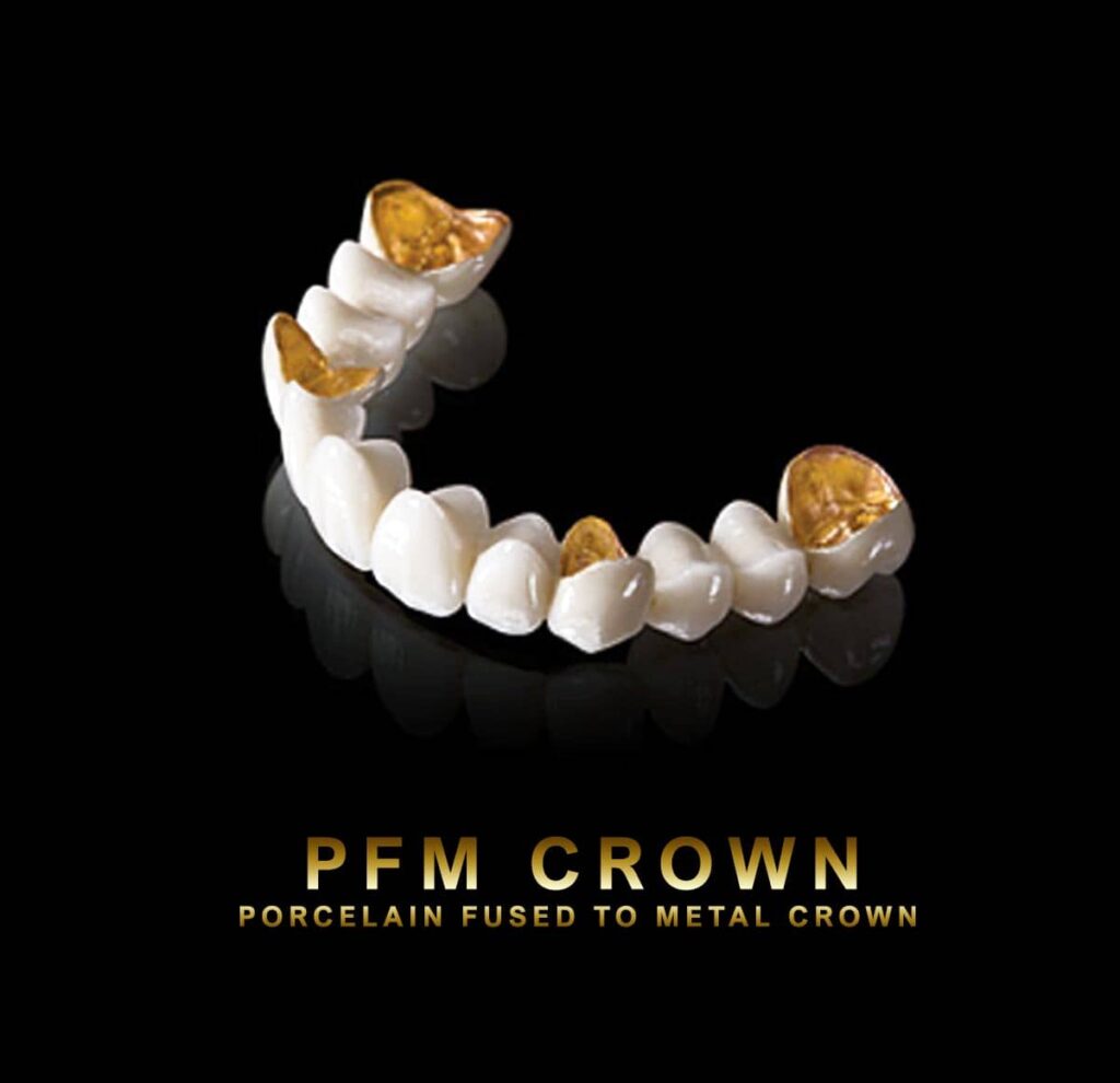 PFM Crown | PFM Bridge | Zirconia & PFM Dental Crown Dubai