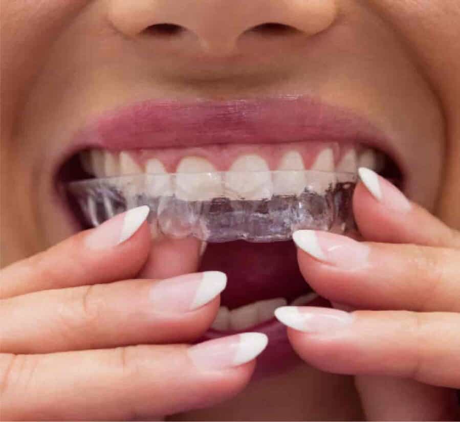 Invisalign Dubai | Best Invisalign Braces Dental Center