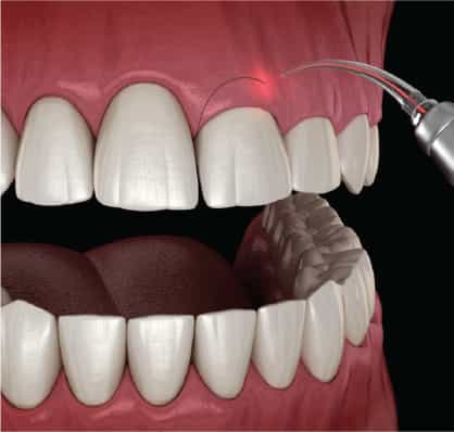 Laser Gingivectomy | Gum Tissue Removal Treatment Dubai