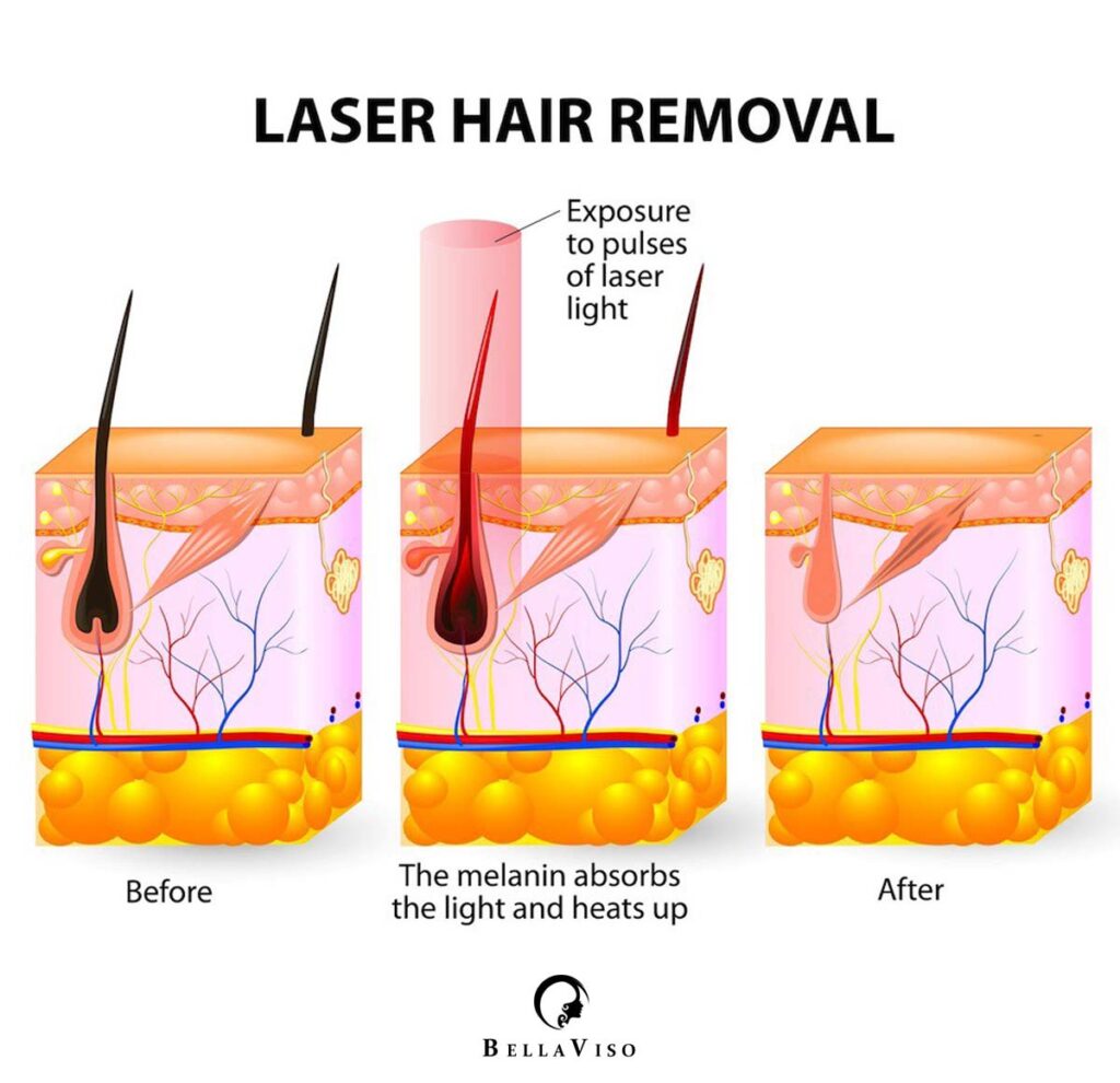 Laser Hair Removal Dubai, UAE | Permanent Full Body Hair Removal