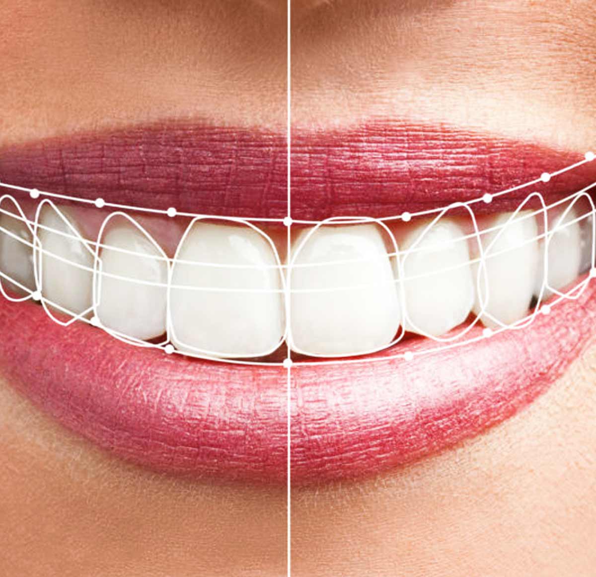 Digital Smile Design (DSD) Clinic in Dubai