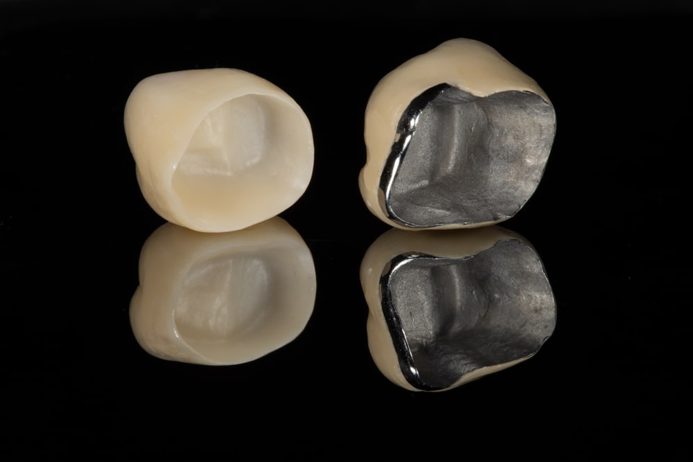 PFM Crown | PFM Bridge | Best Price PFM Dental Crown Dubai