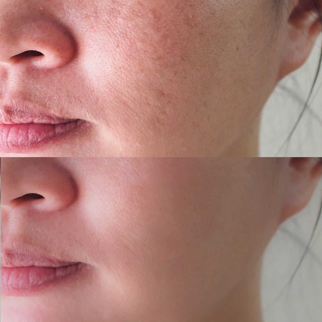 Brightening Facial | Advanced Brightening Facial Treatment in Dubai